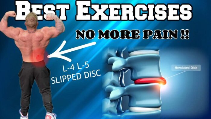 l4-l5-s1 disc bulge treatment without surgery?, exercises to avoid ...