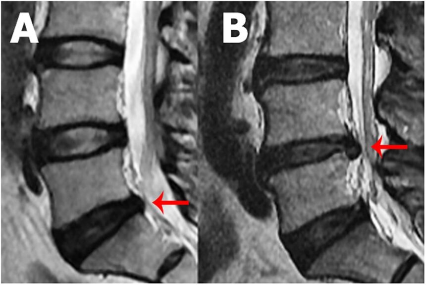 l4-l5 s1 herniated disc bulge treatment exercises? - Dr. Nayan singh ...